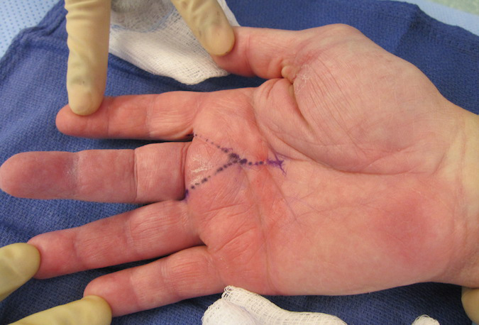 CHONDROSARCOMA | Hand Surgery Resource